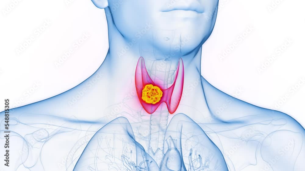3d rendered medical animation of cancer in a man's thyroid gland Stock ...