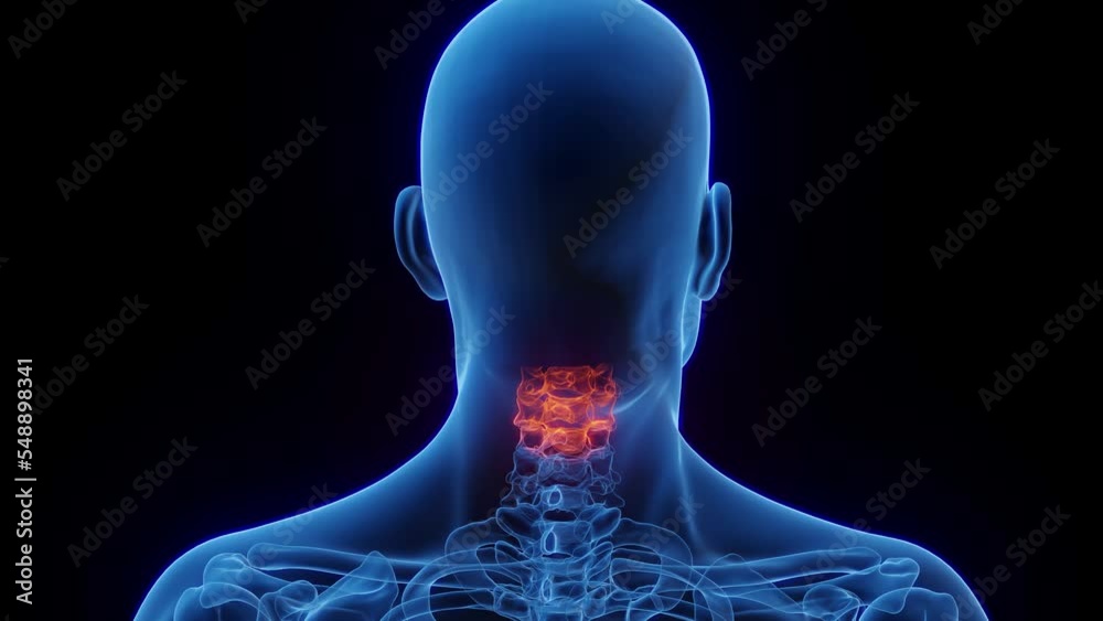 3D rendered Medical Animation of inflammation of a man's Cervical Spine ...
