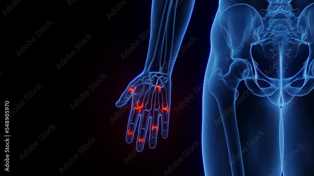 3D rendered Medical Animation of inflammation at the joints of the ...