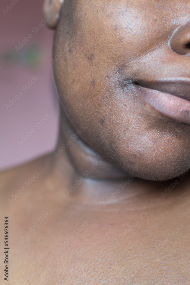 Brown skin with dark spots, hyperpigmentation on brown skin, african ...
