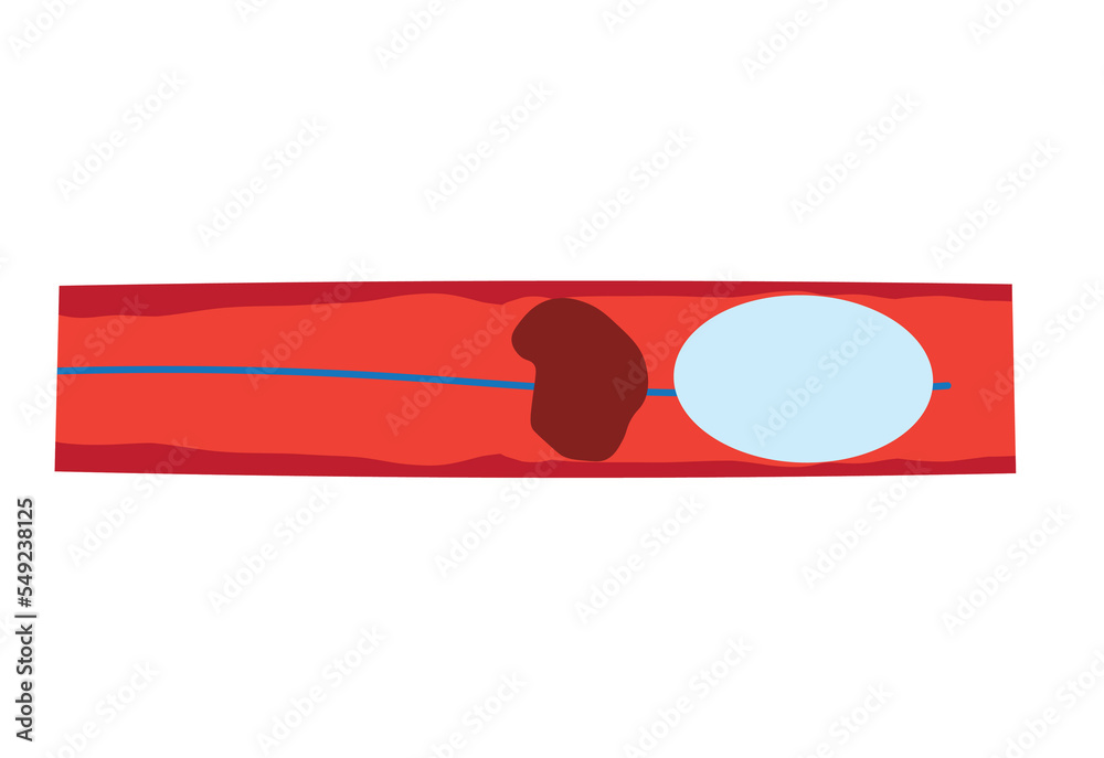 Embolectomy catheter. Fogarty catheter.Removing an emboli in the ...