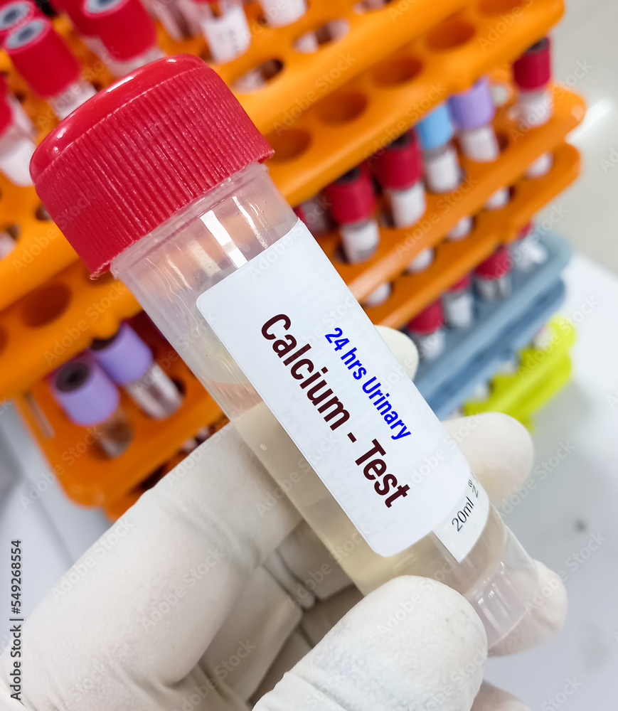 Sample for the measurement of the concentration of 24 hours urine ...