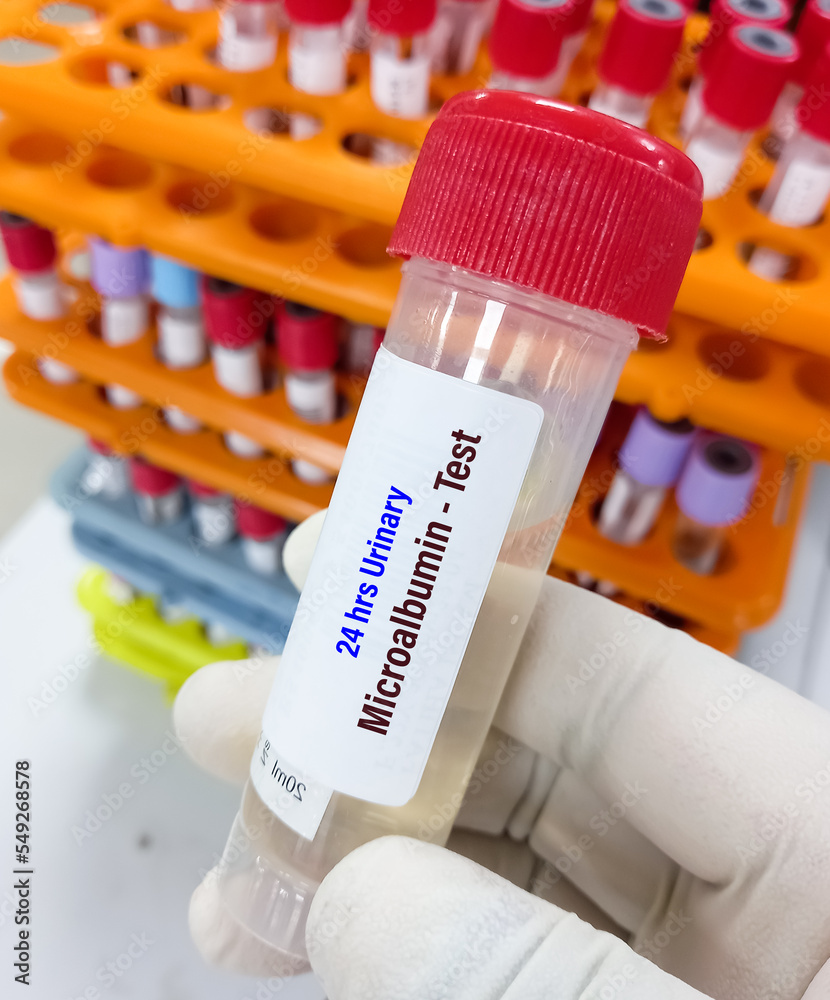 Laboratory test for 24 hours urinary microalbumin test to renal or ...