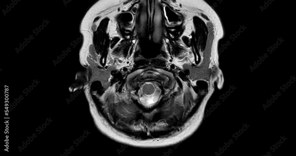 MRI Brain can help doctors look for conditions such as bleeding ...