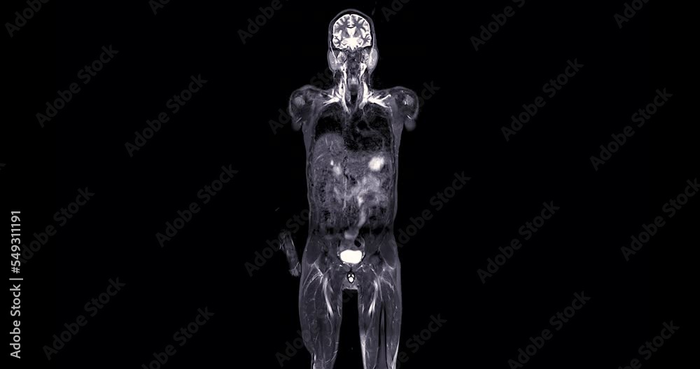 MRI whole body scan Coronal T2 by MRI scanner. Stock ビデオ | Adobe Stock