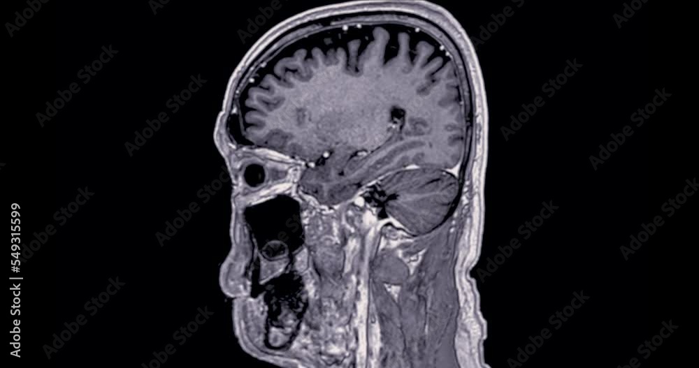 MRI Brain Sagittal T1 3D can help doctors look for conditions such as ...