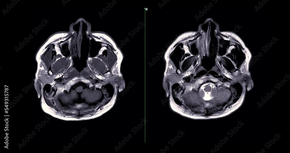 MRI Brain axial T1 and T2 can help doctors look for conditions such as ...