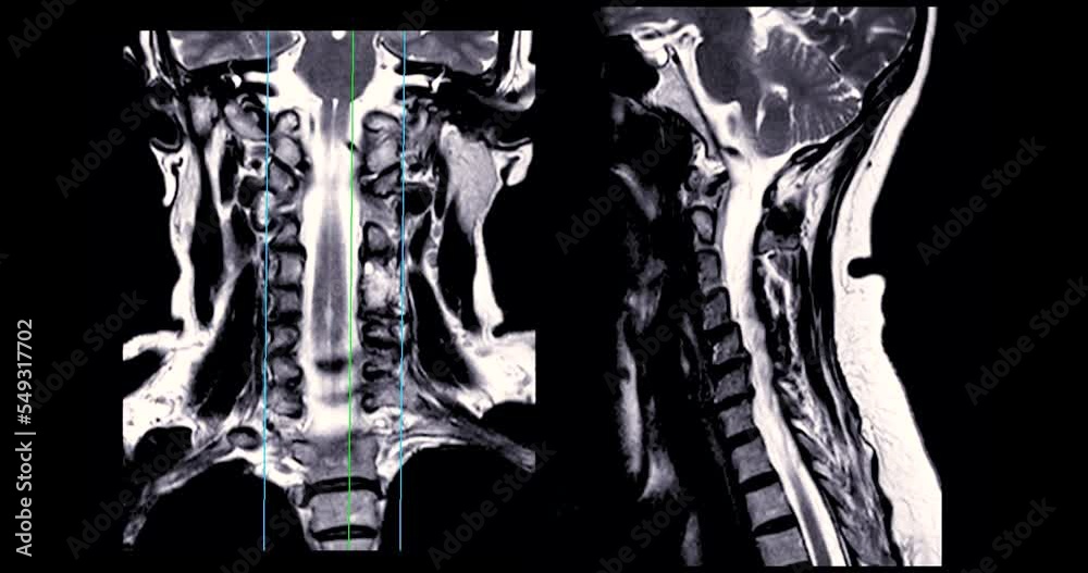 MRI of cervical spine for diagnostic Spinal Cord Compression in patient ...