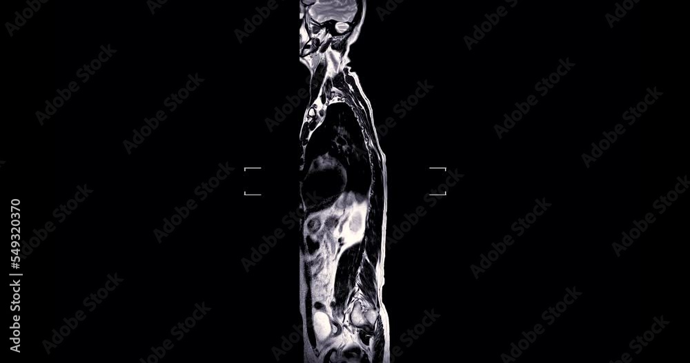 MRI Screening whole spine sagittal T1 showing spine compress spinal ...
