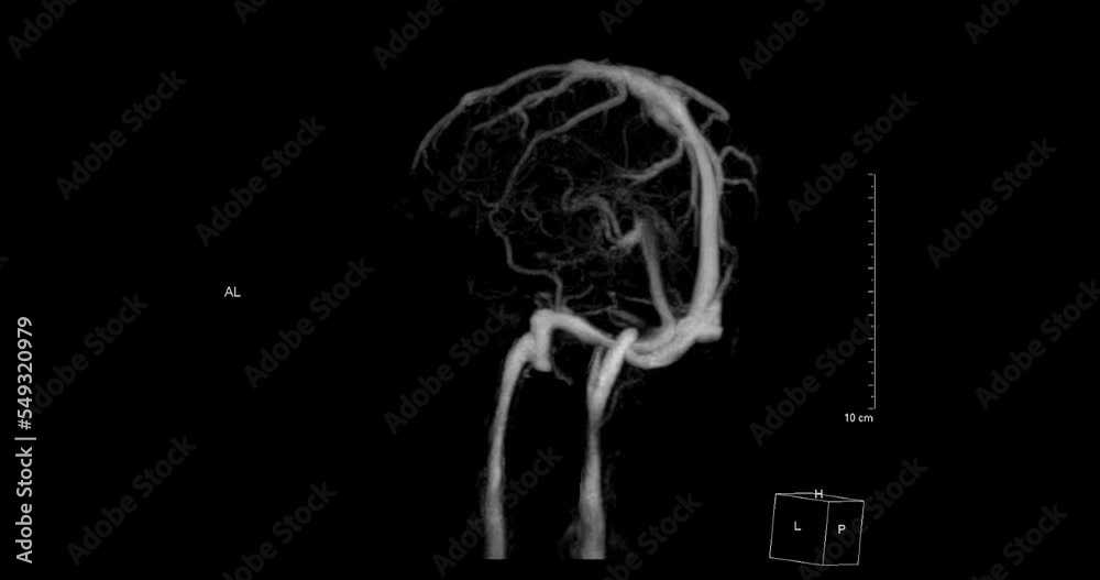 MR cerebral venography (MRV) or MRV Brain for diagnostic Cerebral ...
