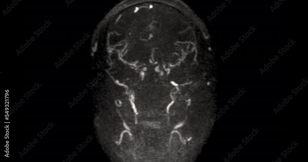 MR cerebral venography (MRV) or MRV Brain for diagnostic Cerebral ...