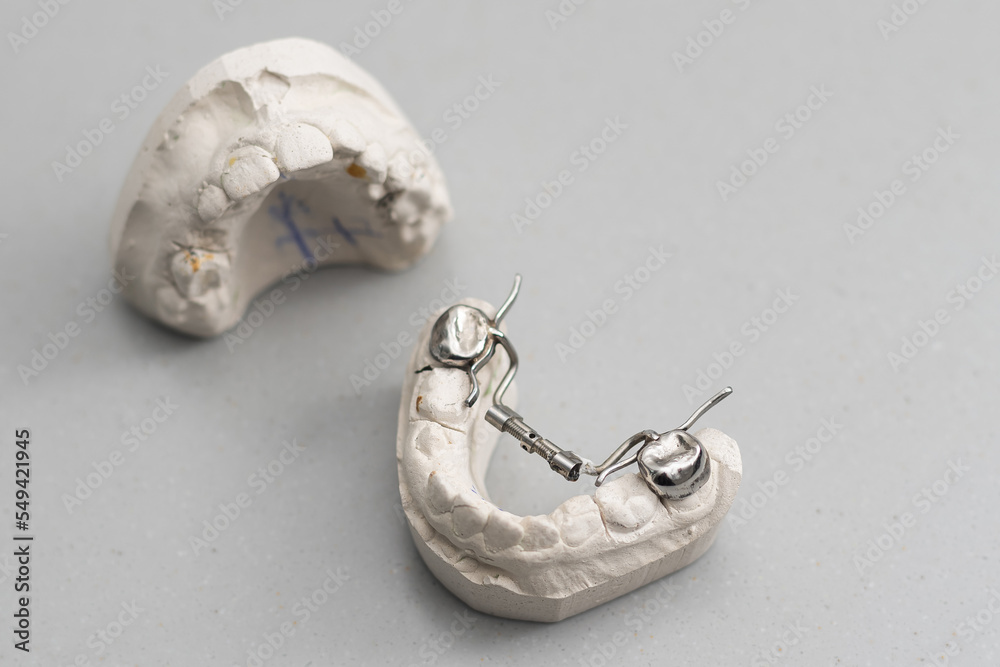 Dental casting gypsum model of human jaws. Crooked teeth and distal ...