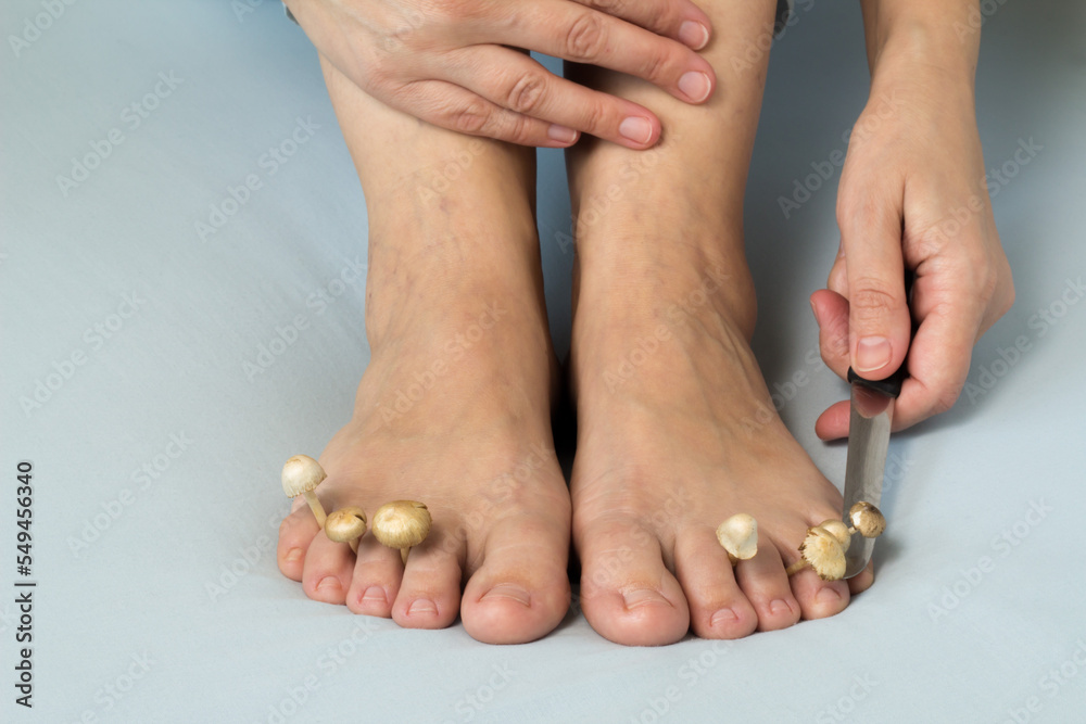 Foto de A woman in despair cuts off a fungus that has grown between her ...