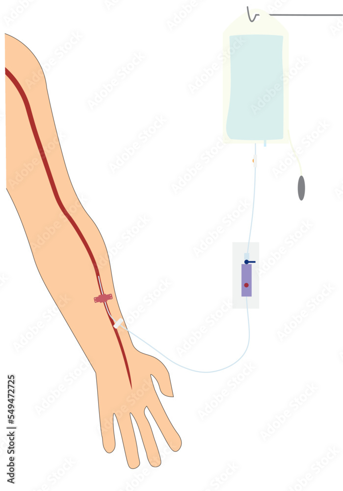 Arterial Line. Invasive arterial blood monitoring system. Hand with an ...