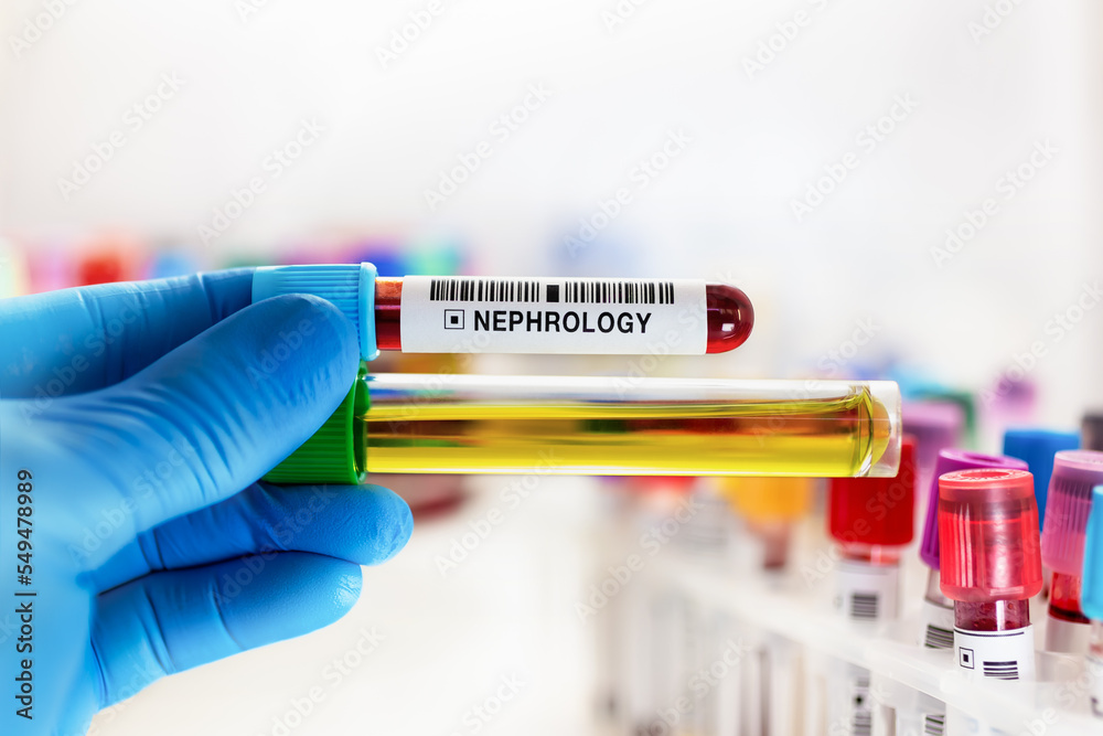 Doctor working with Blood drawn and urine sample for Nephrology test ...