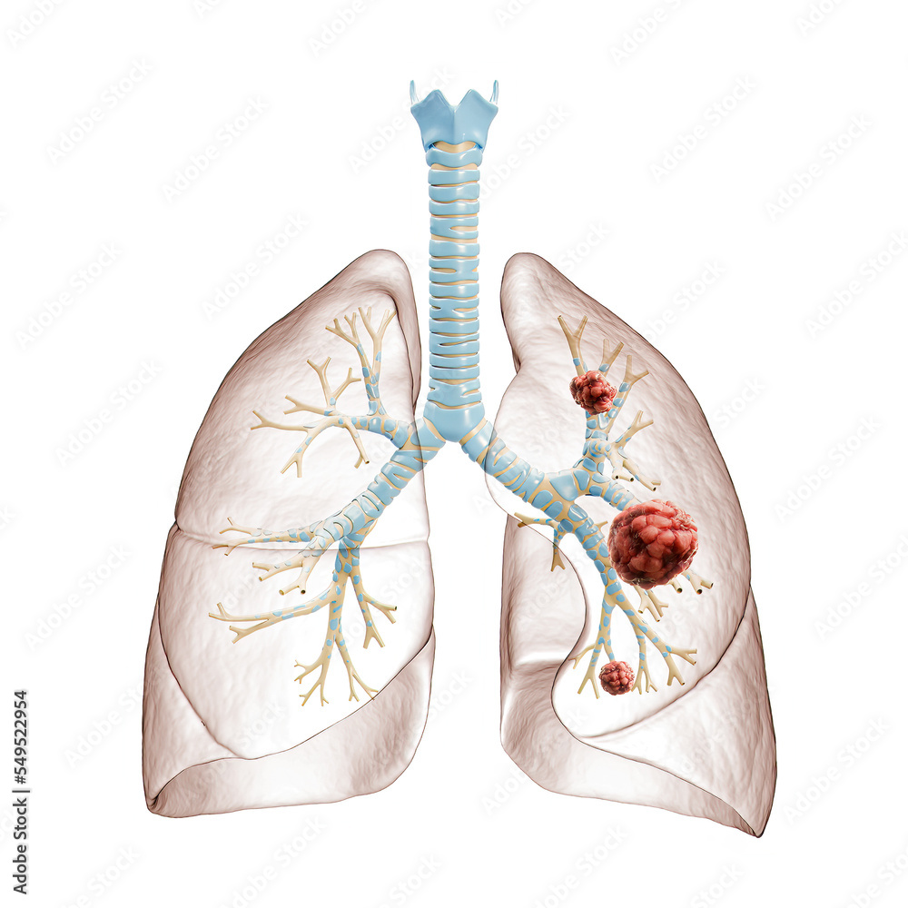 Lung cancer or carcinoma 3D rendering illustration. Bronchial tree and ...