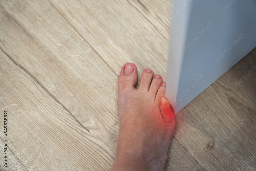 Woman hit furniture with the little toe. Incident at home. Red spot ...