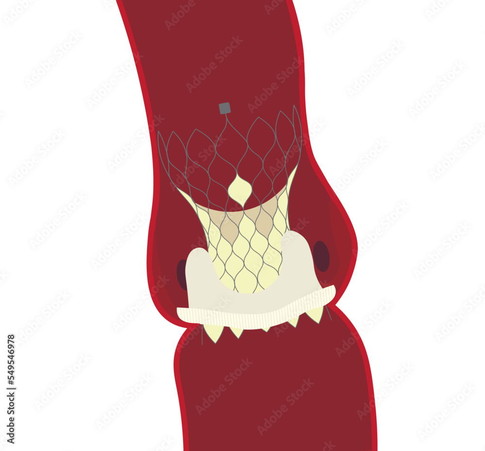 Valve-in-valve transcatheter aortic valve replacement (ViV TAVR). Heart ... Valve-in-valve transcatheter aortic valve replacement (ViV TAVR). Heart ...