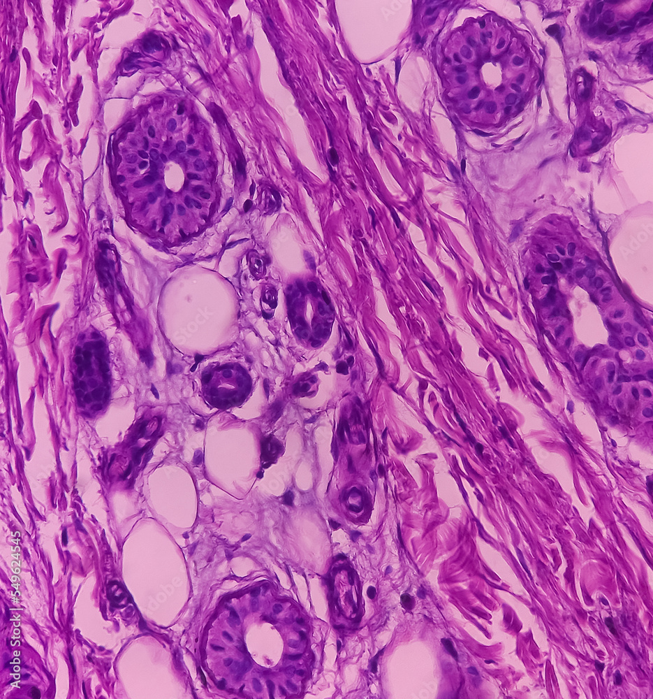 Finger biopsy, finger cancer, Invasive squamous cell carcinoma, grade ...