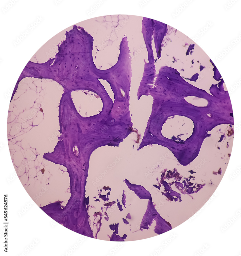 Finger biopsy, finger cancer, Invasive squamous cell carcinoma, grade ...
