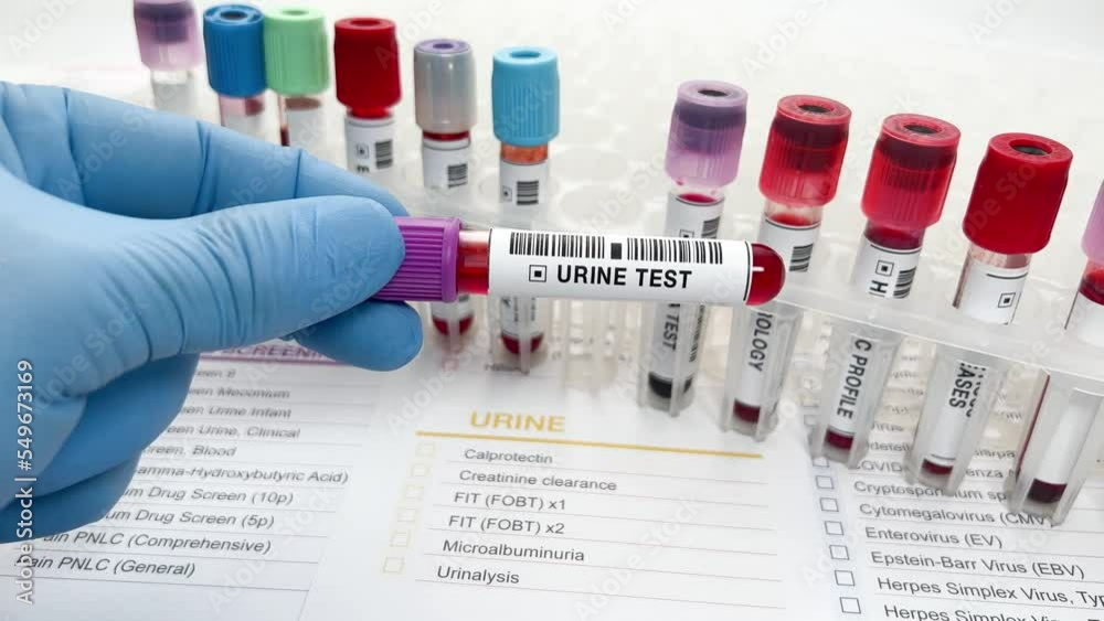 Doctor hand with blood sample for Urine test in the chemistry ...