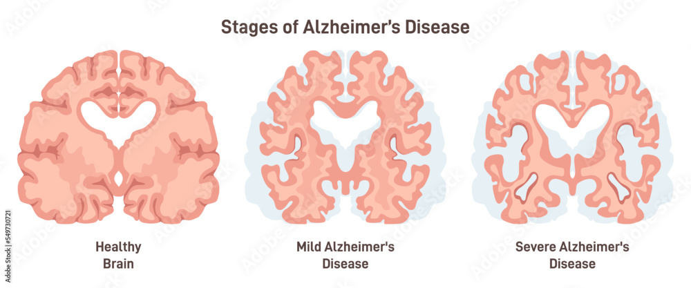 Alzheimer's disease stages. Human brain cross section, affected with progressive Stock Vector ...