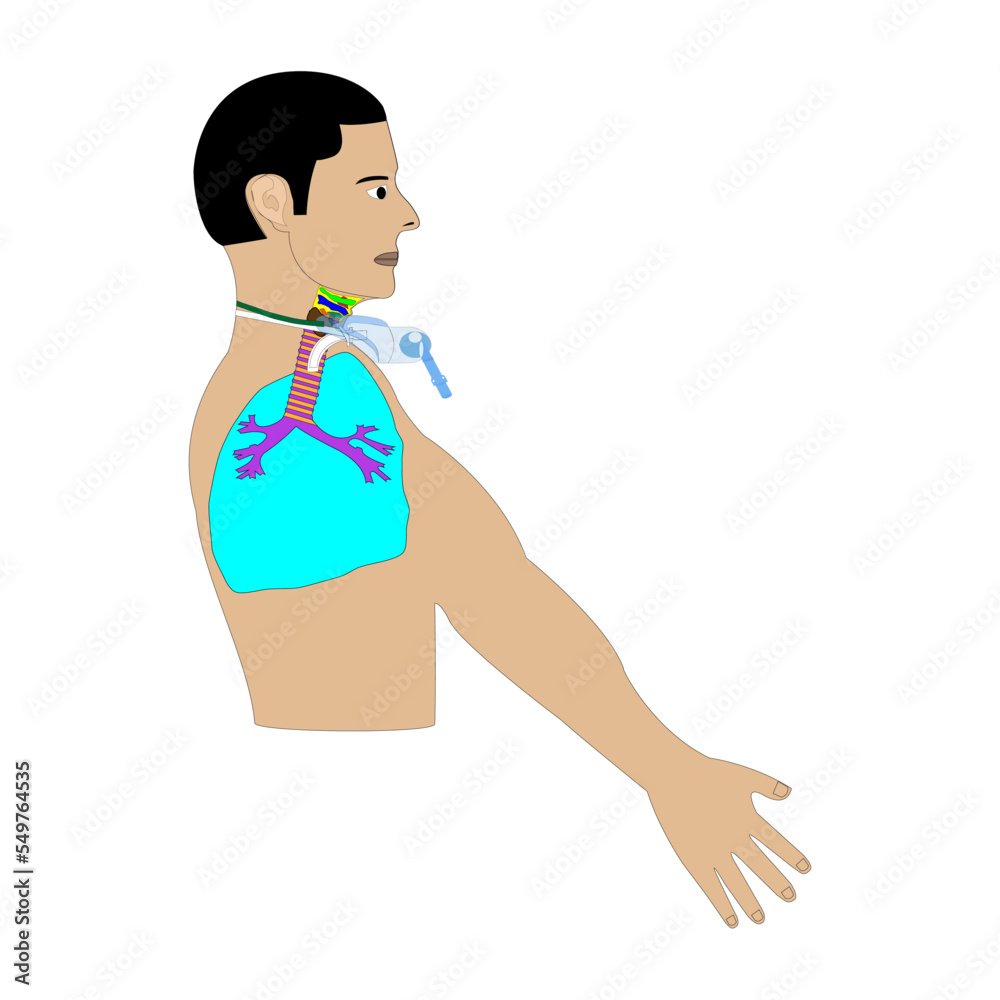 Radiografía y topografía de un paciente con mascara de traqueostomía y ...