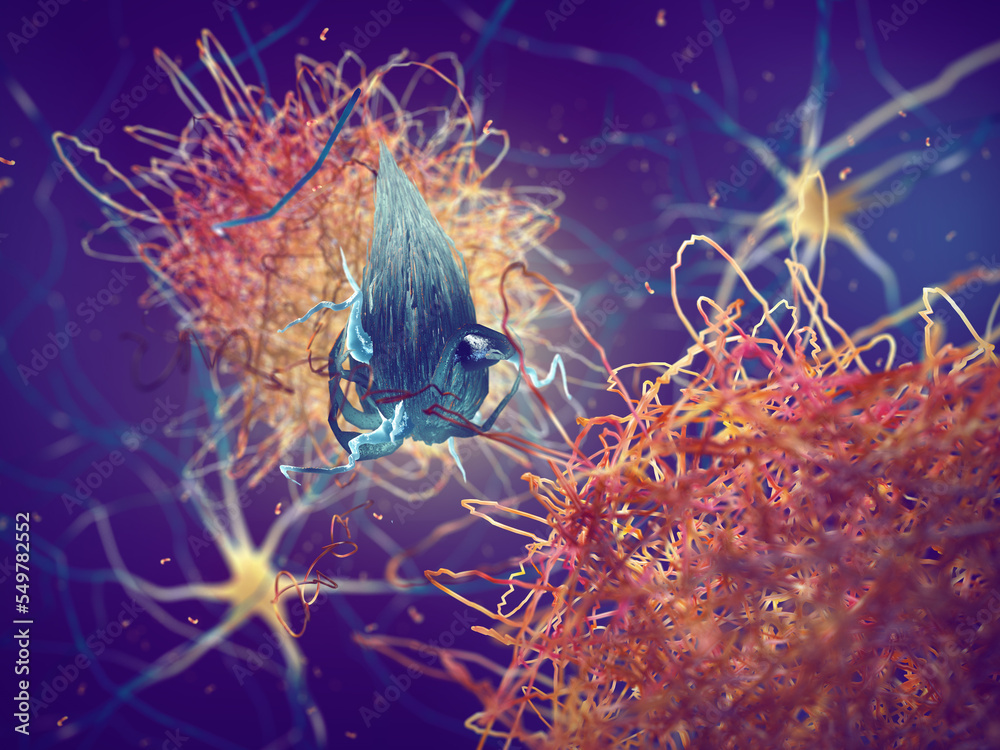 Poster Damaged nerve cell (neuron) and amyloid plaques – Wall Art ...
