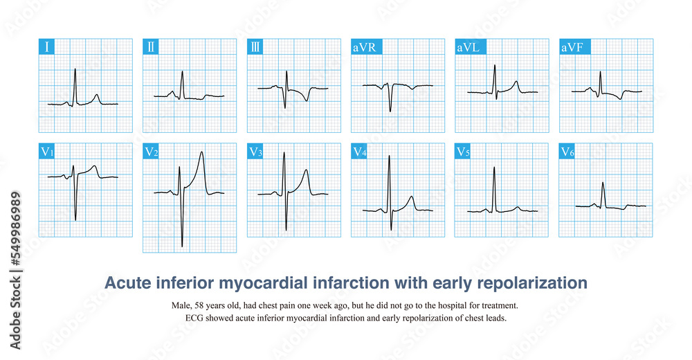 Early repolarization is mostly a benign ECG change, and ST segment ...