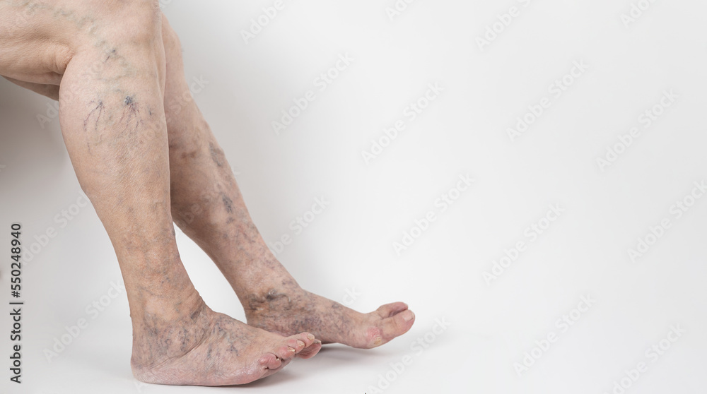 Painful varicose veins and spider veins on active women's legs, helping ...