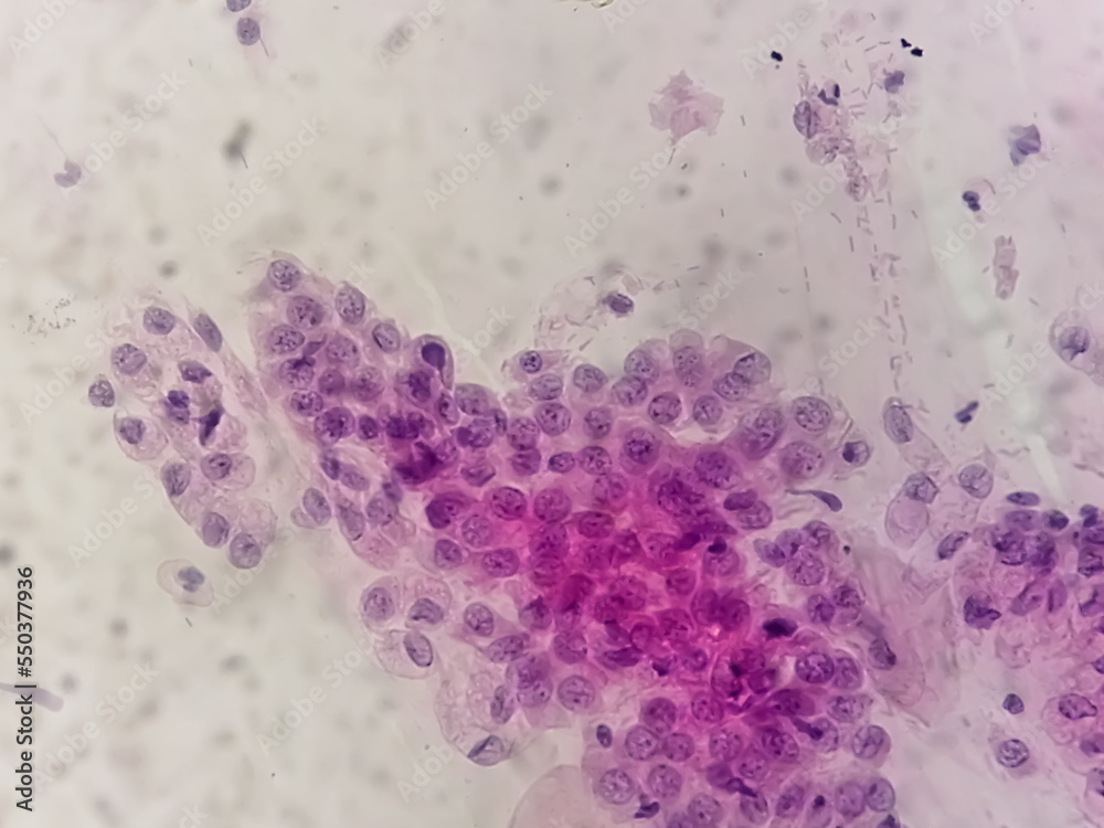 Microscopic view of Trichomonas vaginalis in pap smear with few acute ...