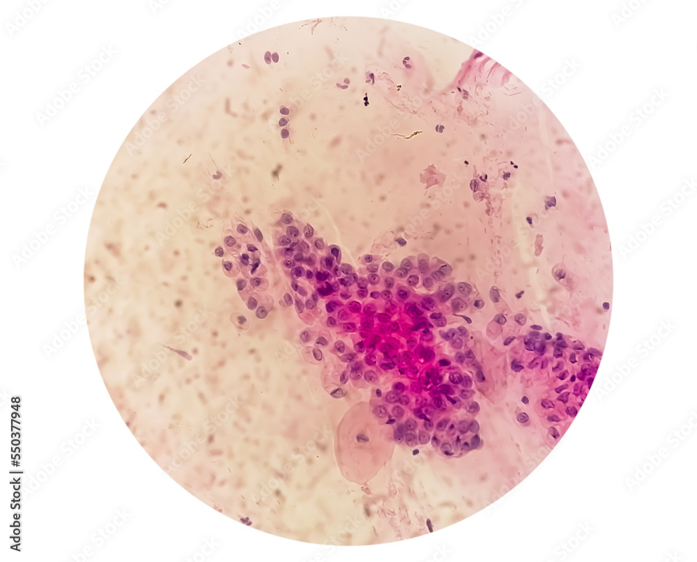 Microscopic view of Trichomonas vaginalis in pap smear with few acute ...