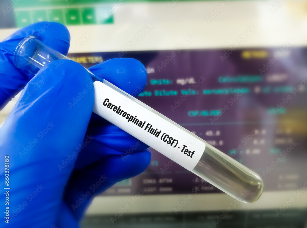 Cerebrospinal fluid (CSF) study including biochemistry, cytology, Gram ...