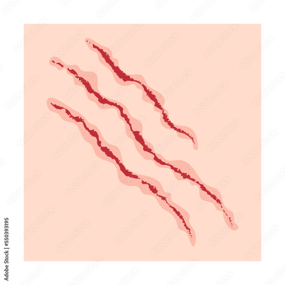 Scar with stitches cartoon illustration. Bloody wound, injures ...