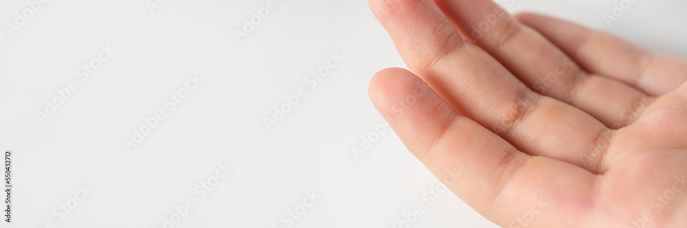Wart on the finger. Close-up of a wart on a child's finger. The common ...