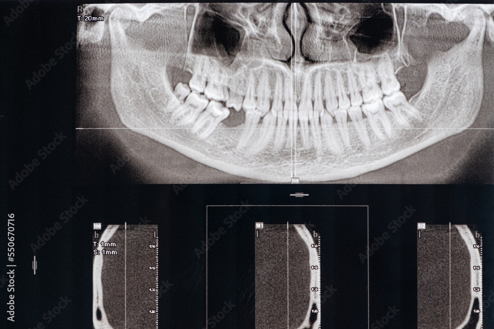 CT scan of a patient with missing chewing tooth and malocclusion Stock ...