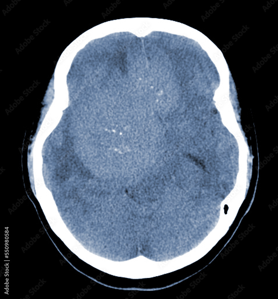 CT Brain Axial scans hyperdense mass with homogeneous, and mild ...