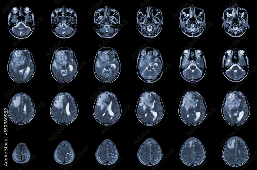MRI Brain Axial views .to evaluate brain tumor. Glioblastoma, brain ...