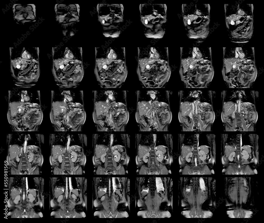 Magnetic resonance imaging (MRI)OF UPPER ABDOMEN of a patient who has ...