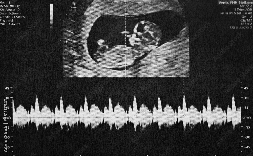 Pregnant baby infant ultrasound display. Mother belly screen in ...