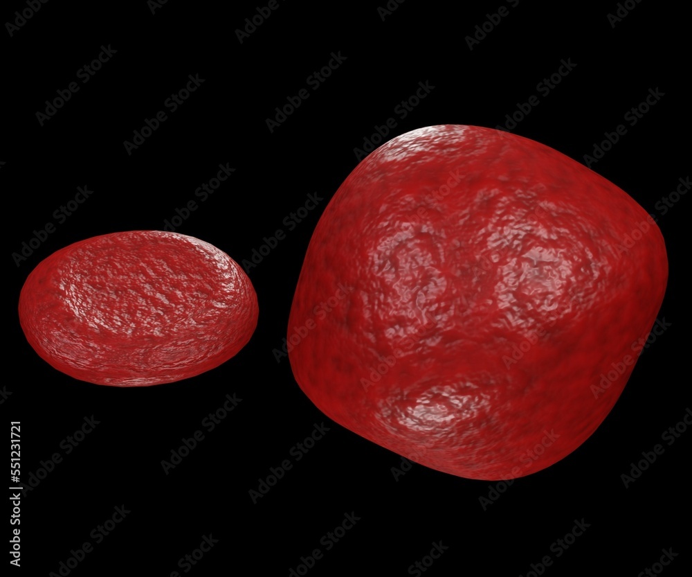 Isolated swollen erythrocyte with normal red blood cell. Macrocytic ...