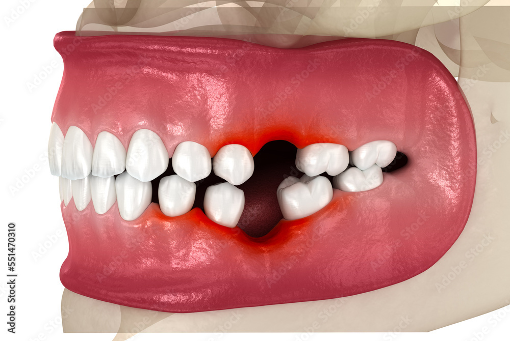 Teeth shift deformatiuon after losing molar tooth. 3D illustration of ...