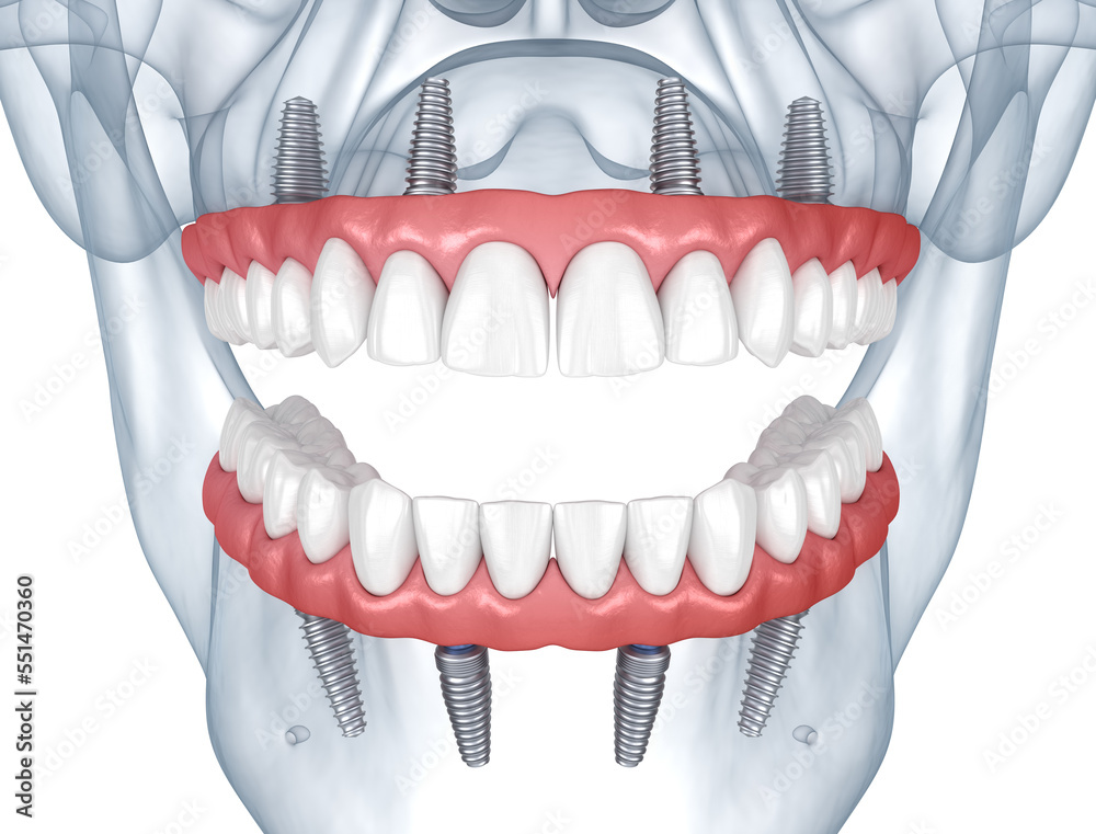 Prostheses supported by 8 implants. Dental 3D illustration Stock ...