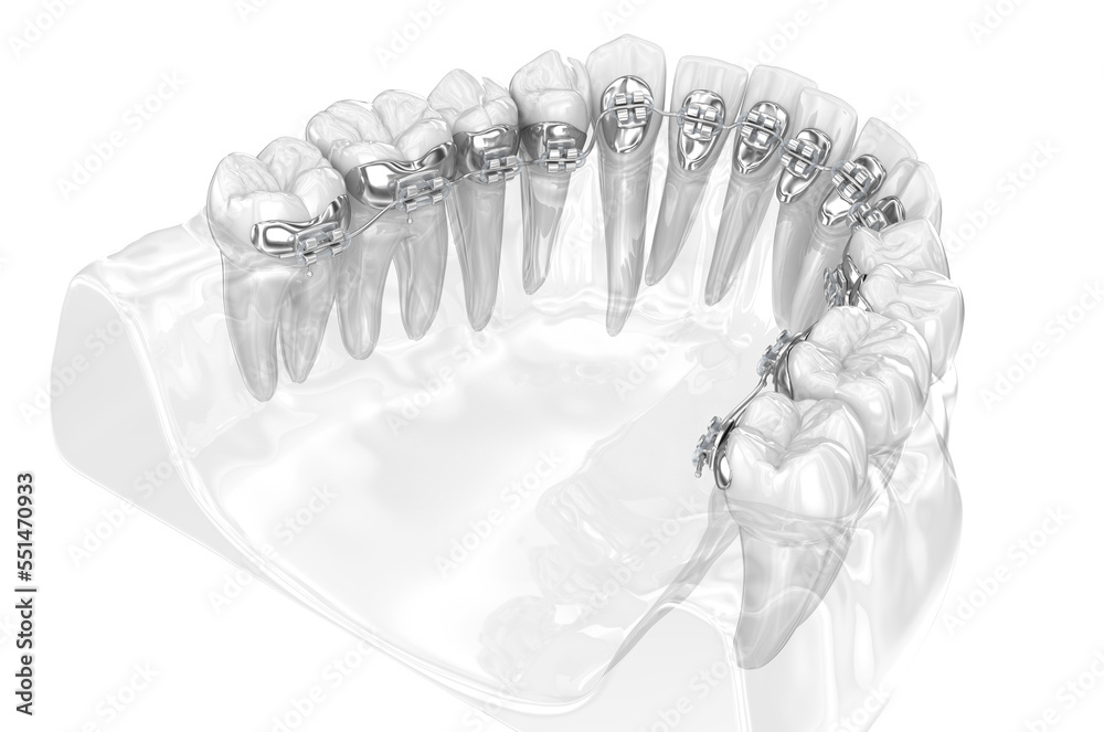 Lingual braces system. 3D illustration concept of golden braces Stock ...