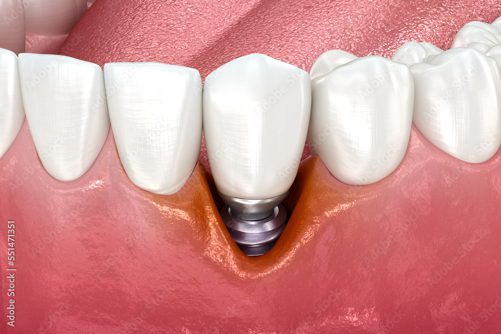 Peri-implantitis with visible gingiva recession. Medically accurate 3D ...