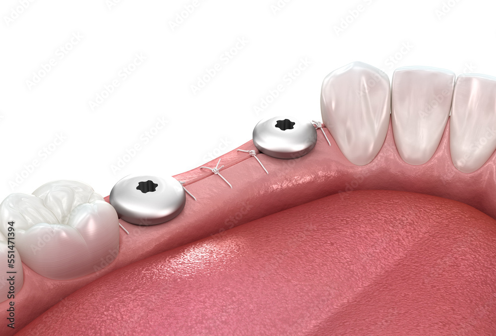 Gingiva former over implant. Medically accurate 3D illustration. Stock ...