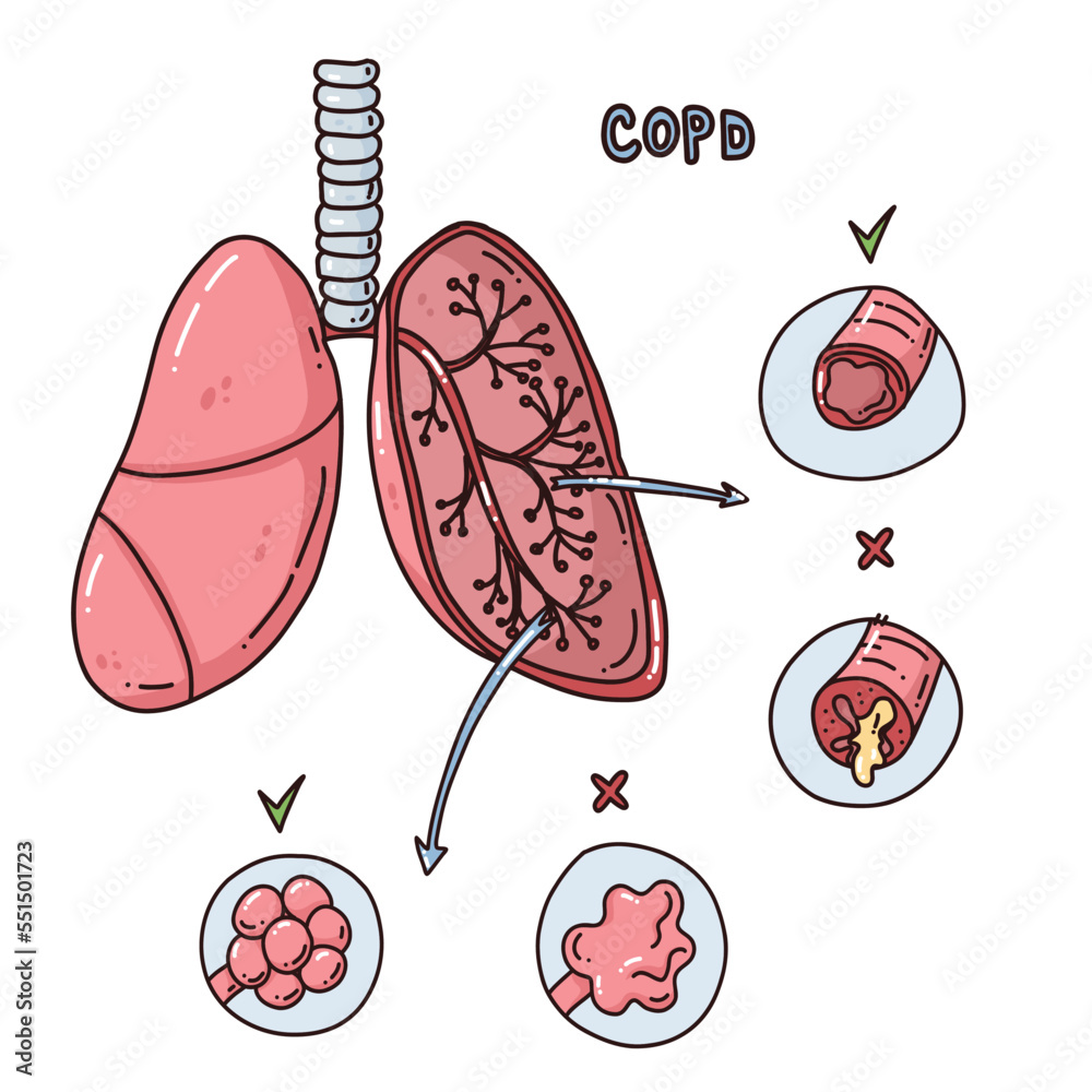 copd illustration. human lungs, cute vector illustration Stock Vector ...