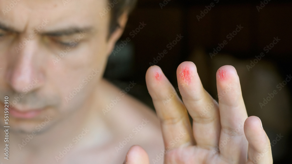 Sad unhappy man showing his painful hand with injured fingers. Work ...
