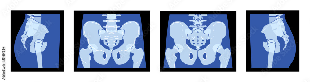 Poster Set of X-Ray pelvis Skeleton Hip Human body Bones adult people ...