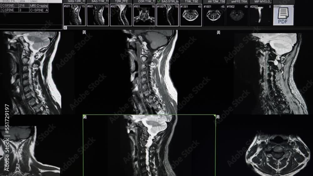 Cervical spine MRI scan of a patient with neck and shoulder pain showing disc bulging and spinal ...